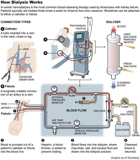 Hemodialysis Diagram Media Portfolio