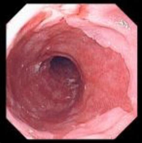 Upper Gi Disorders Flashcards Quizlet