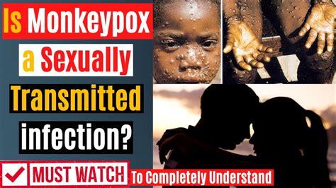 Is Monkeypox A Sexually Transmitted Infection Monkeypox Virus Monkeypox Outbreak YouTube
