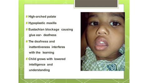 Adenoidhypertrophy 1pptx For Medical Student Pptx