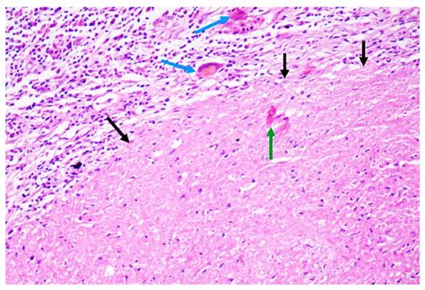 Scielo Brasil Testicular Tuberculosis Testicular Tuberculosis