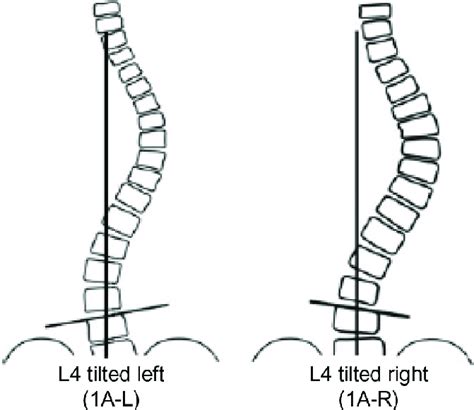 Determination Of L4 Tilt Direction In Lenke 1a Curves Note Adapted