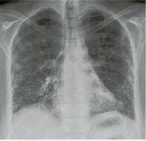 Padrões Reticular E Reticulonodular Colégio Brasileiro De Radiologia Download Scientific