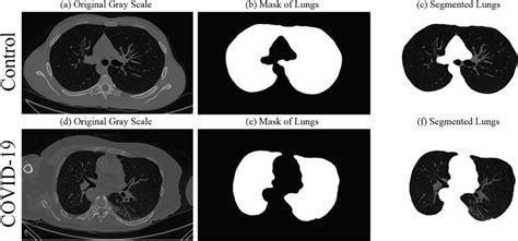 Sample Control Patients A Original Grayscale Image B Lung Mask C