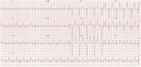 Electrolyte Abnormalities Saem