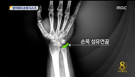손목 해부학 엑스레이