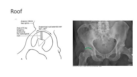 Acetabulum Fractures Anatomy Radiological Evaluation Classification