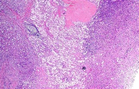Xanthogranulomatous Pyelonephritis Histology
