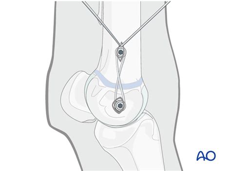 Growth Retardation For Angular Limb Deformities