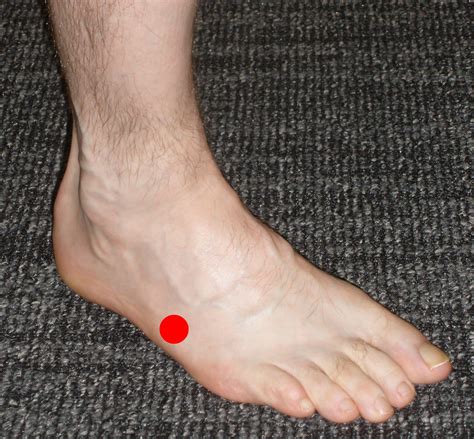 5th Metatarsal Avulsion Fracture Footeducation