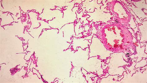 6 Emphysema Pulmonis Pathology
