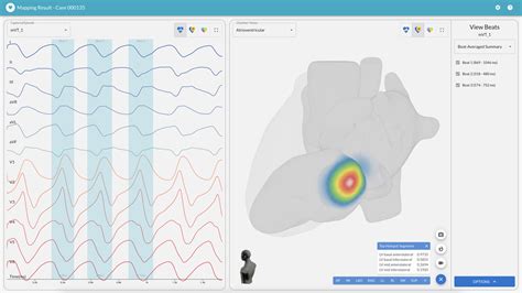 Vektor Medical Launches Vmap Software Enhancements Cardiac Rhythm News