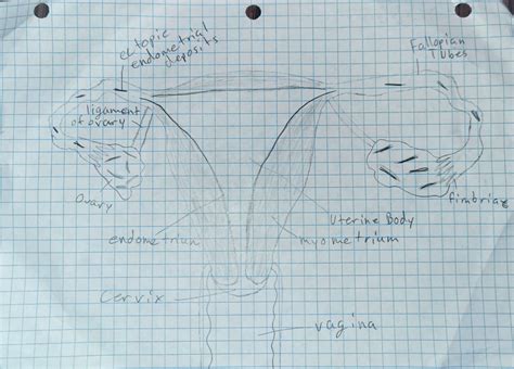 Endometriosis In The Female Reproductive System Human Steam
