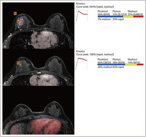 Response Evaluation To Neoadjuvant Chemotherapy In Breast Cancer Patients Sequential Dynamic