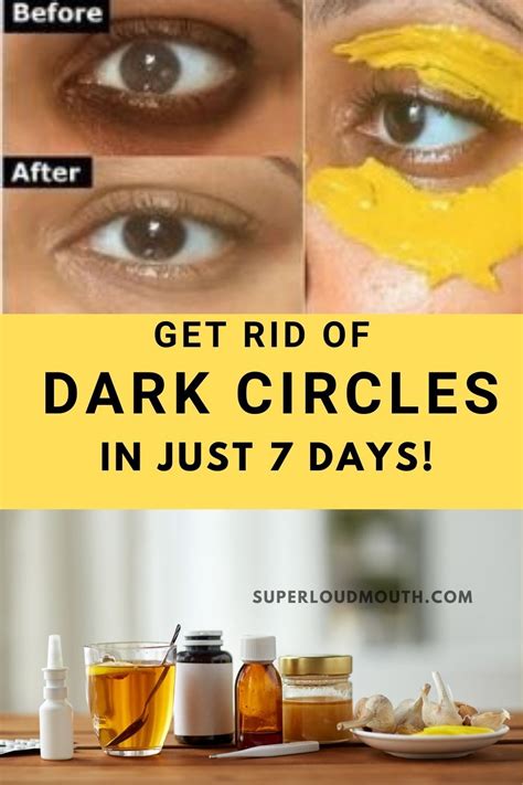 What Deficiency Causes Dark Circles Under Eyes Artofit
