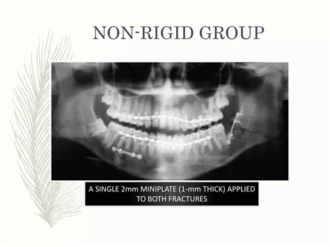 Open Reduction And Internal Fixation Of Combined Angle And Bodysymphysis Fractures Of The