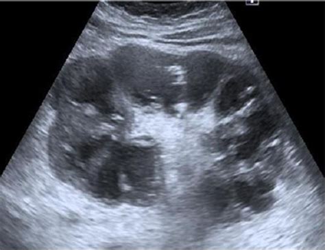 Xanthogranulomatous Pyelonephritis Bears Paw Sign