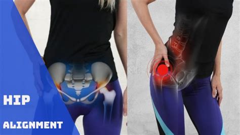 Hip Misalignment Symptoms Causes Treatment Prevention
