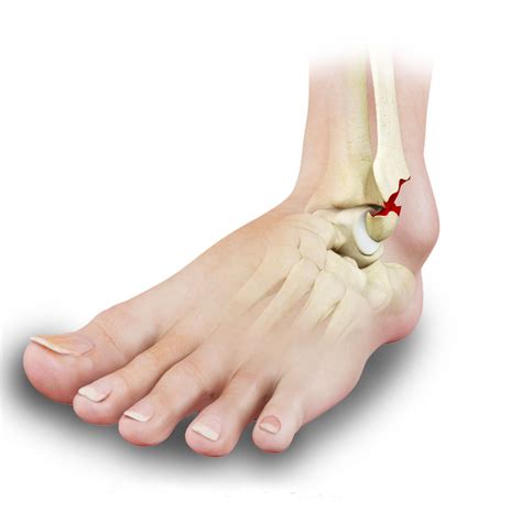 Ankle Fracture Quotes