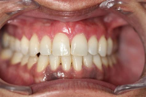 ¿qué Causa Las Encías Oscuras O Melanosis Gingival — Esprohident