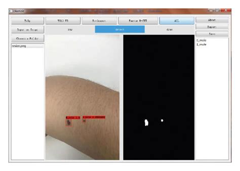 Mole Detection And Segmentation After Running The Object Detection