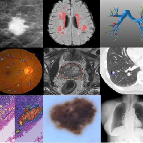 PDF A Review On Progress In Semantic Image Segmentation And Its Application To Medical Images