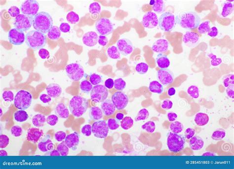 Chronic Myeloid Leukemia Cells Or Cml Stock Image Image Of Slide