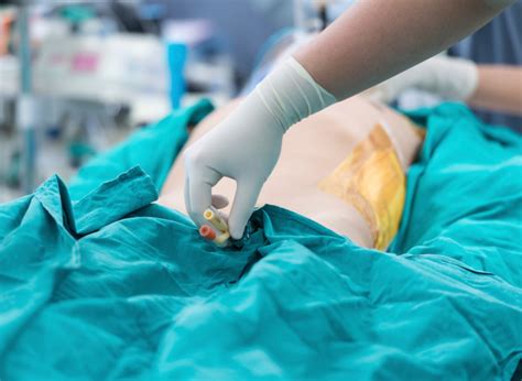 Transurethral Resection Tur Bladder Perforation May Worsen Outcomes