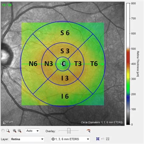 Representative Spectralis® Sd Oct Scans Of Macular Thickness Map Etdrs