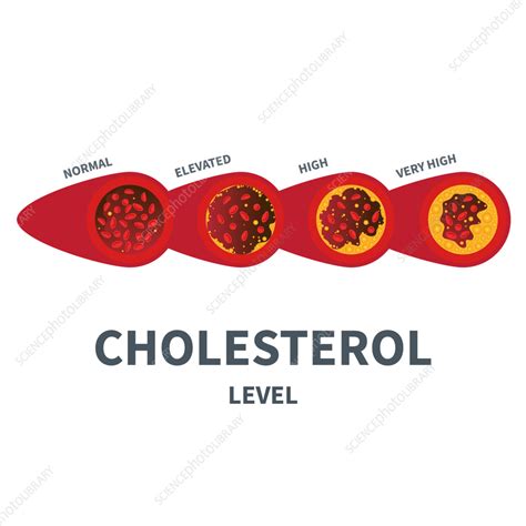 Cholesterol Conceptual Illustration Stock Image F041 5712 Science Photo Library