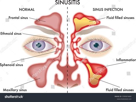 Medical Illustration Symptoms Sinusitis Stock Vector Royalty Free