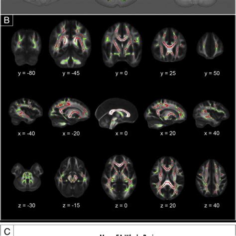 Exploratory Whole Brain Analysis Results Whole Brain Tbss Results A