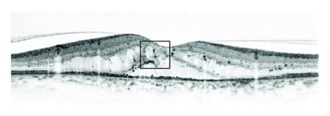 A Representative Case With Hyperreflective Foci Arrowheads In Download Scientific Diagram