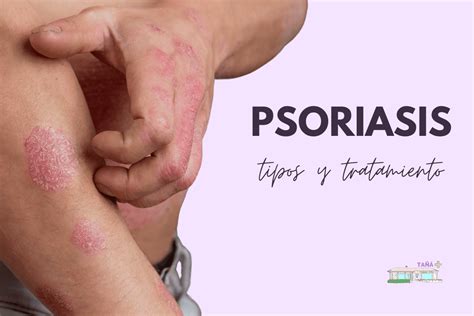 ¿qué Es La Psoriasis Tipos Y Tratamiento El Blog Tañá