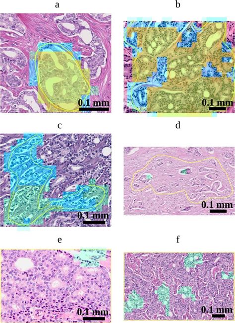 Cribriform Growth Pattern Detection On Images From The Dataset Of