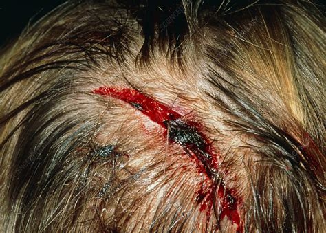 Laceration Head