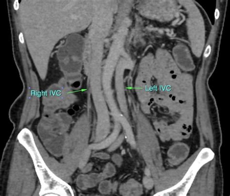 Duplication Of Inferior Vena Cava Pacs
