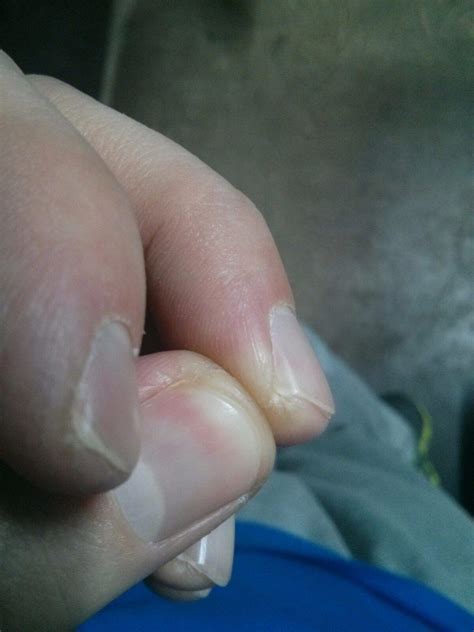 Трескается кожа на пальцах рук причины почему около ногтей портится кожа