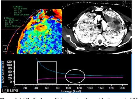 Figure 1 From Dual Layer Spectral Ct As Innovative Imaging Guidance In
