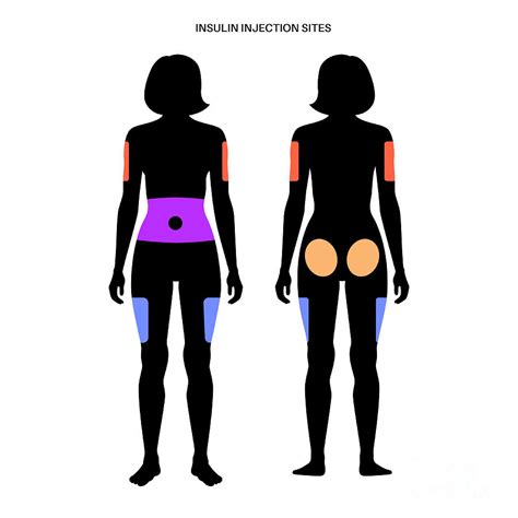 Insulin Injection Sites Photograph By Science Photo Library Pixels
