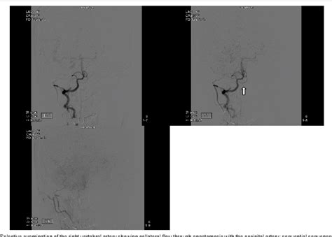 Figure 2 From External Carotid Artery Steal Syndrome Via Occipital Vertebral Anastomosis