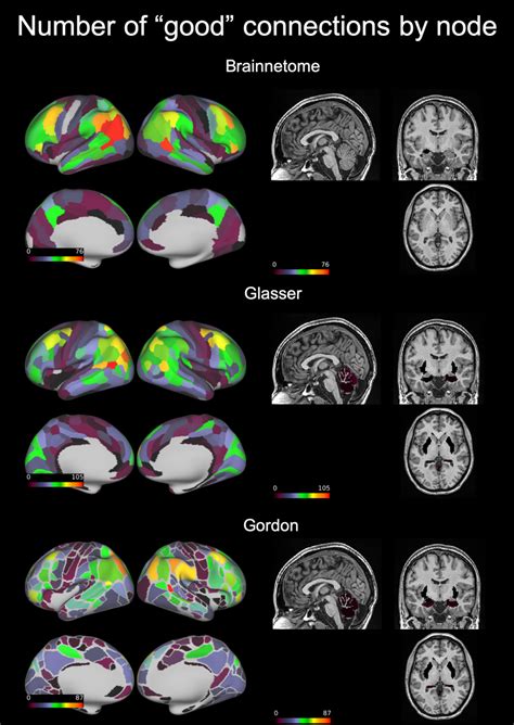 Number Of Functional Connections With Good Reliability By Node On An