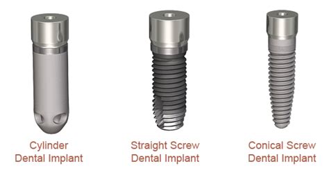 Tooth Implant Types
