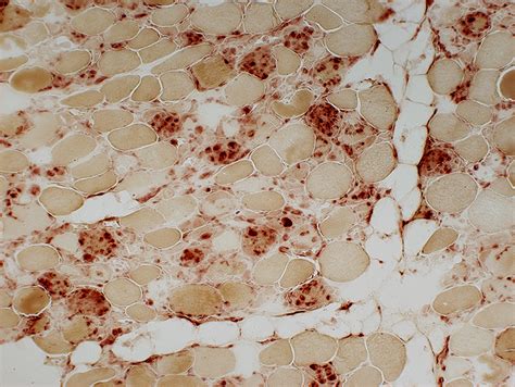 Muscle Fiber Necrosis