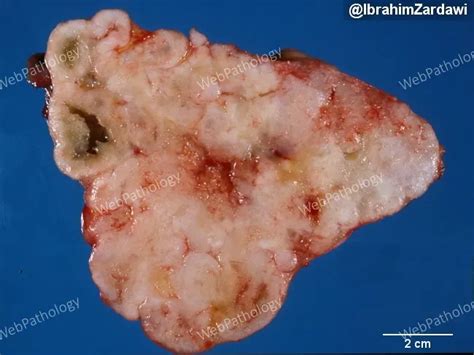 Chondrosarcoma