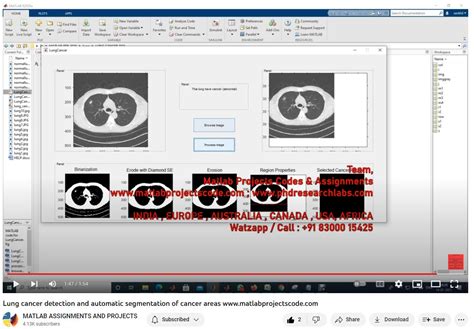 lung cancer detection and automatic segmentation of cancer areas