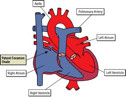 Patent Foramen Ovale Pfo Centennial Hjerte Hjerte Kar Konsulenter