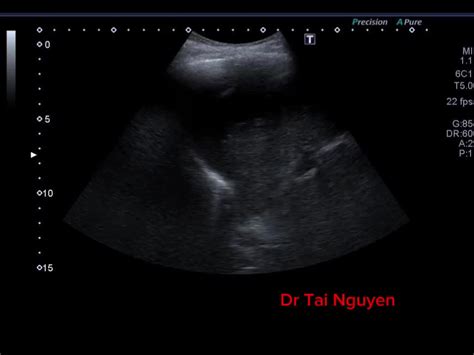 Tan Tai Nguyen On Linkedin Medtronic Emprint Microwaveablation