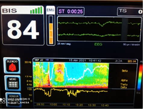 Non Convulsive Epiletic Seizure After Electroconvulsive Therapy Session