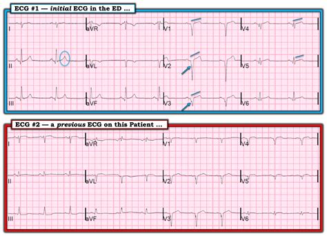 Is This New Lad Occlusion With St Elevation Superimposed On Old Qs Wave Mi Dr Smiths Ecg Blog